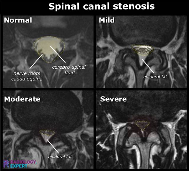 MRI Lumbar Spine